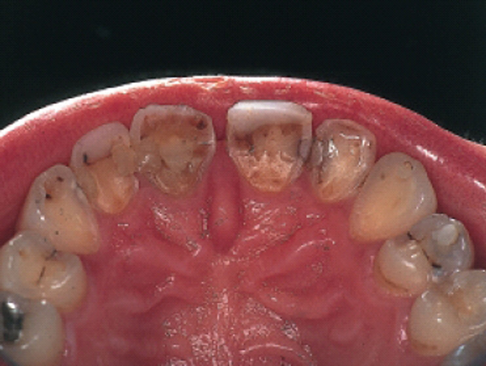 Tanderosie | SpringerLink