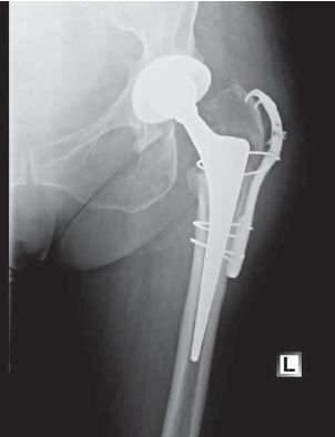 Ernstige complicatie van gecannuleerde heupschroeven bij mediale ...