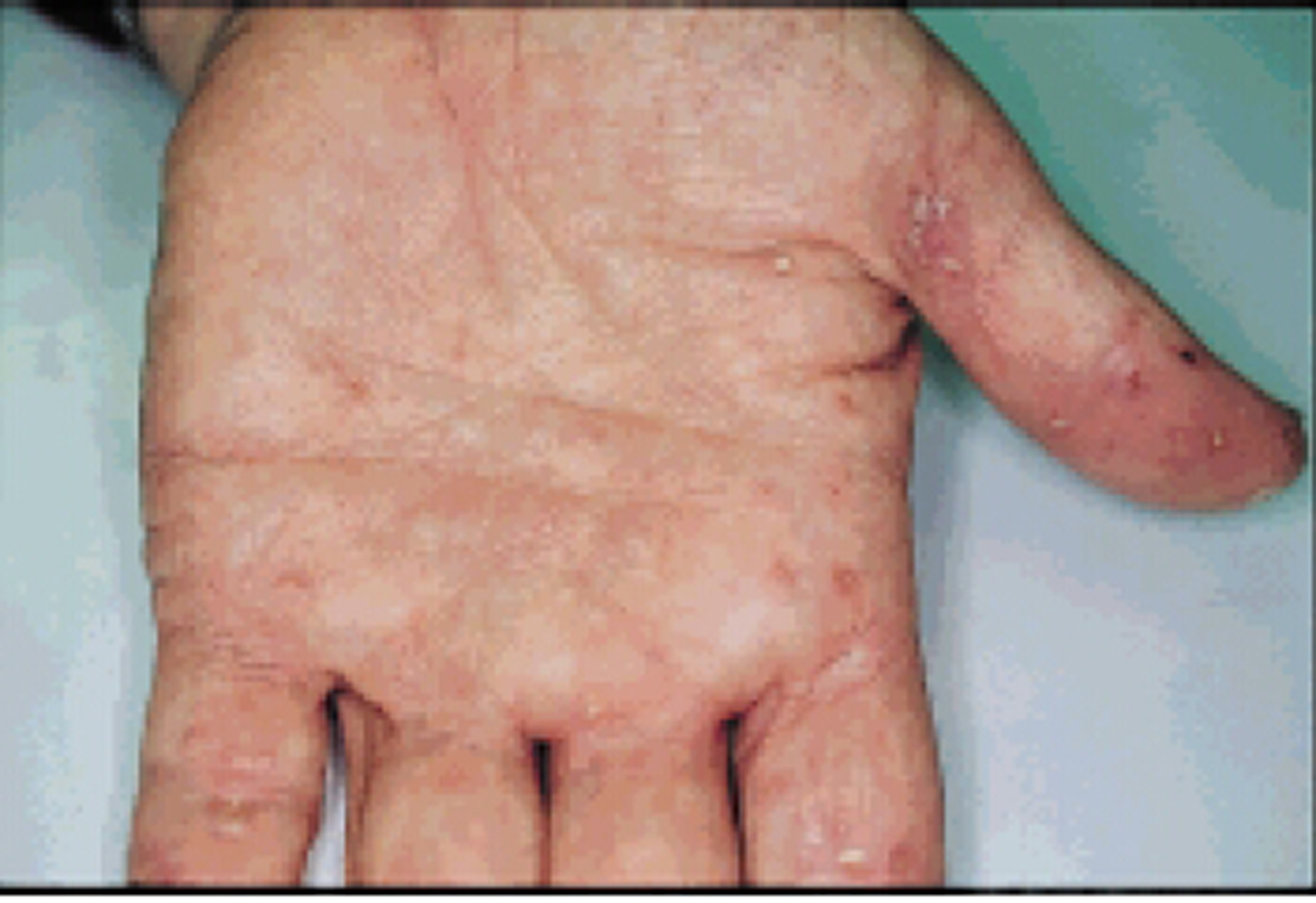 Eczeem | SpringerLink