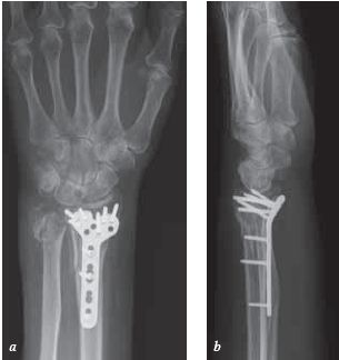 Miskend letsel van de elleboog bij een ipsilaterale proximale ...