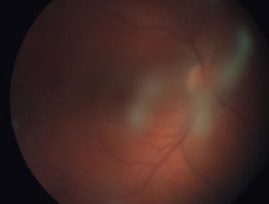 Immunopathogenic Background of Pars Planitis | SpringerLink