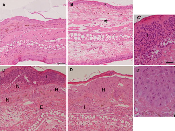 Pathogenesis of skin ulcers: lessons from the Mycobacterium ulcerans ...