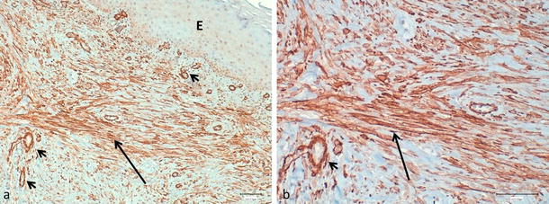 The myofibroblast, a key cell in normal and pathological tissue repair ...