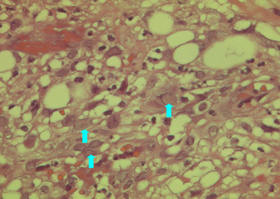 Proktitis – aus gastroenterologischer Sicht | SpringerLink