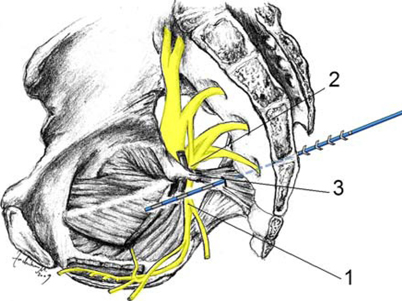 Erste Erfahrungen mit der Stimulation des Nervus pudendus bei ...