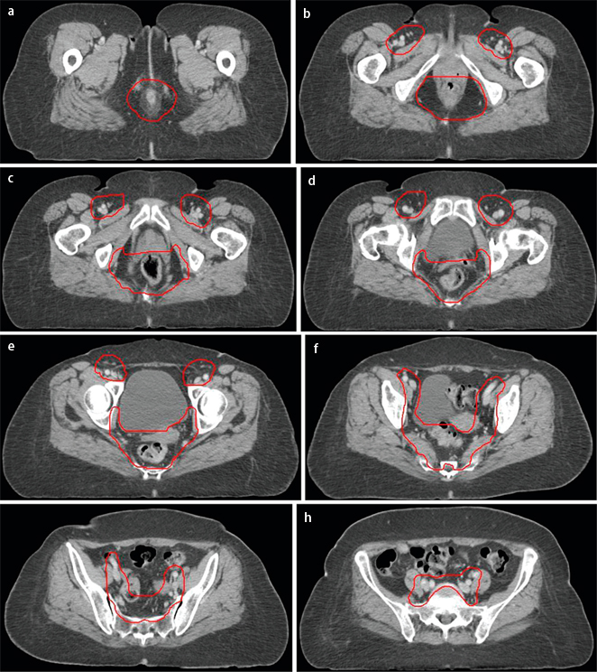 Radiochemotherapie des Analkarzinoms | SpringerLink