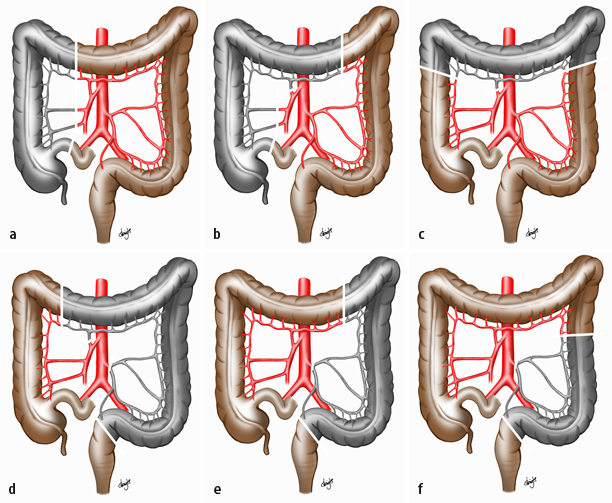 Tubuläre rektumresektion vs. transanale rr