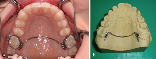 Symmetric and asymmetric expansion of molars using a Burstone-type ...