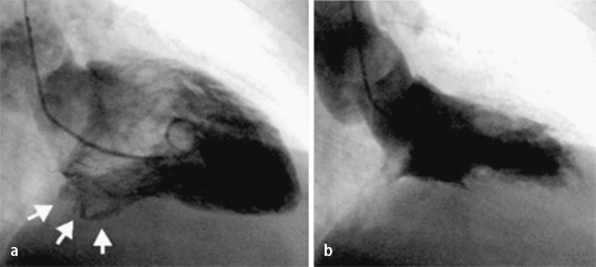 Multiple left ventricular inferoseptal clefts | SpringerLink