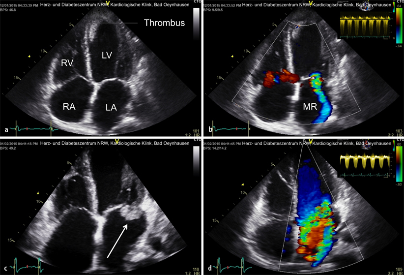 Mikrobiell verursachte Endokarditis | SpringerLink