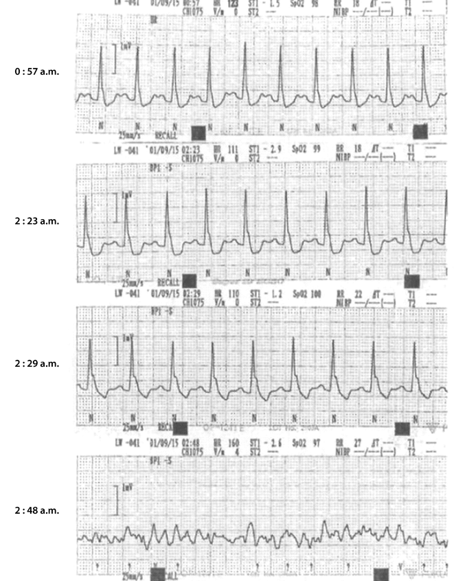 The Osborn wave: what have we learned? | SpringerLink