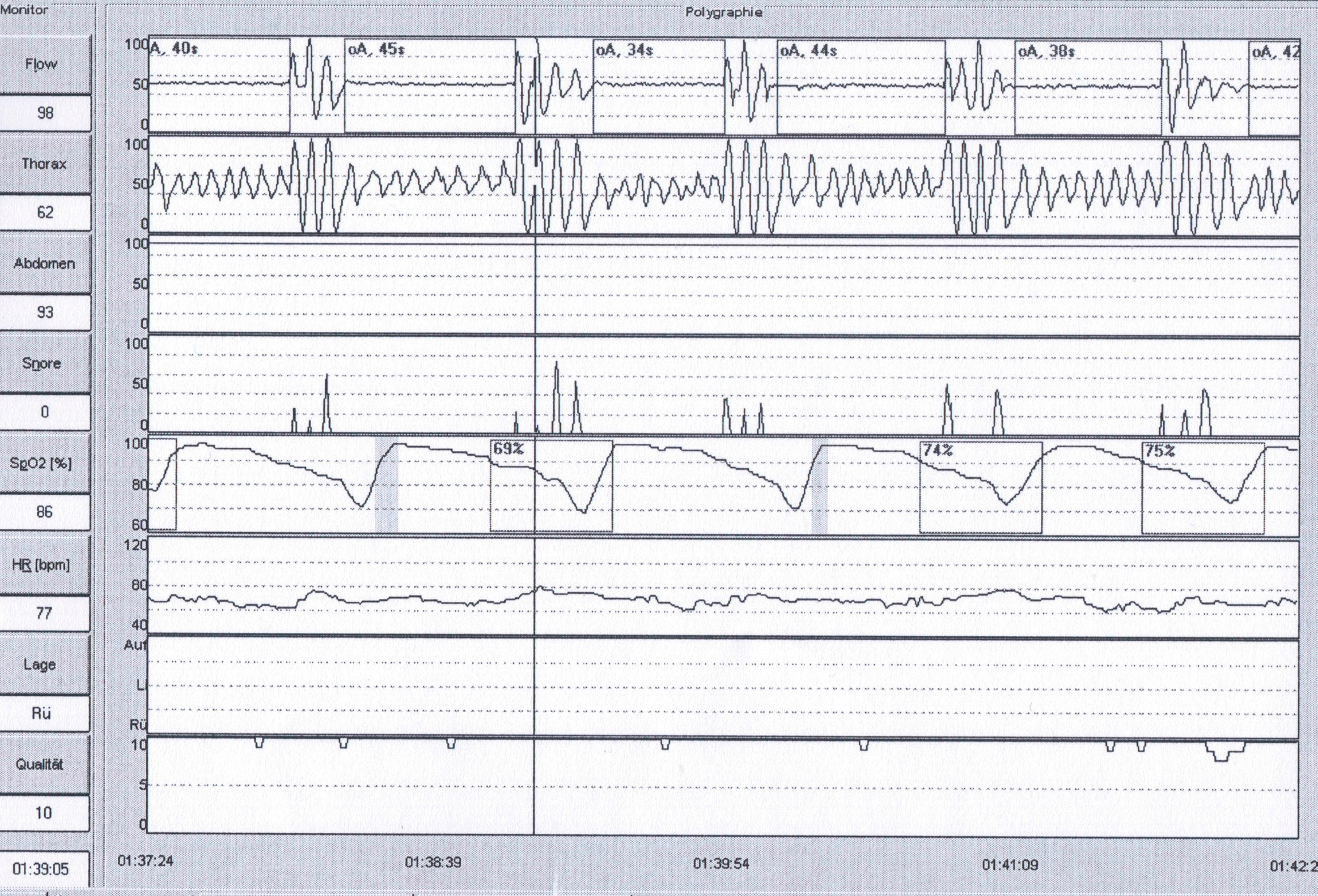 Die ambulante Polygraphie richtig eingesetzt | SpringerLink