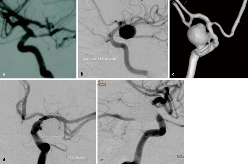 Evolution from an Infundibulum of the Posterior Communicating Artery to ...