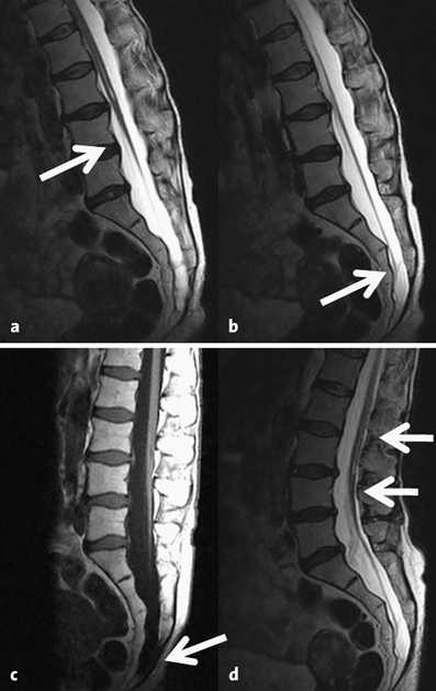 Features of Positional Magnetic Resonance Imaging in Tethered Cord ...