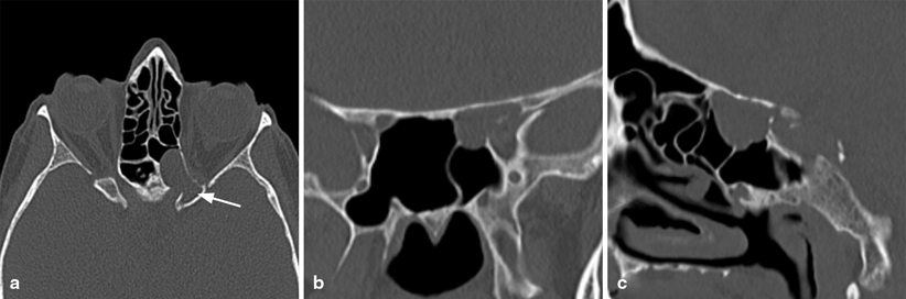 Onodi Cell Mucocele Causing Acute Vision Loss | SpringerLink