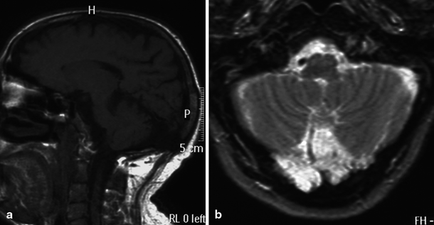 Hypertrophic Arachnoid Granulation of the Occipital Bone | SpringerLink