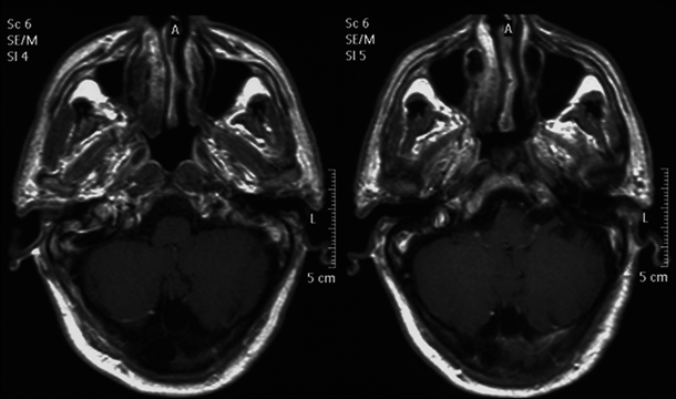 Hypertrophic Arachnoid Granulation of the Occipital Bone | SpringerLink