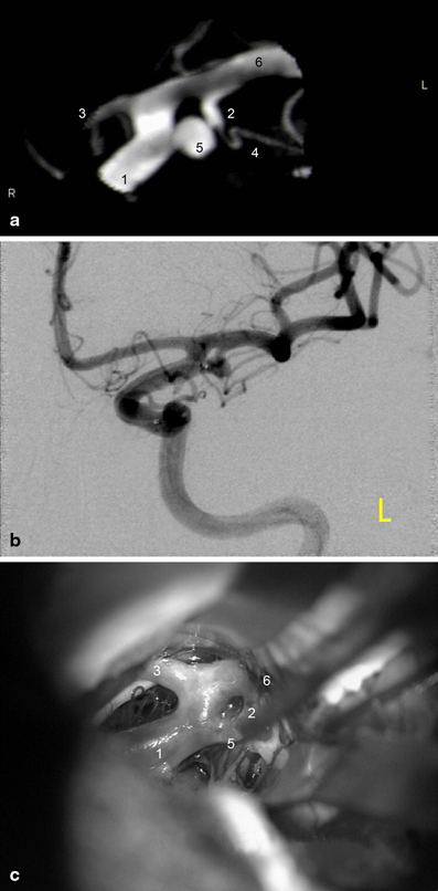A Rare Case of Supraclinoid Internal Carotid Artery (ICA) Fenestration ...