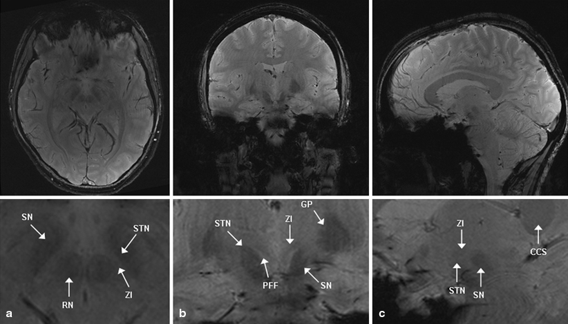 Visualisation of the Zona Incerta for Deep Brain Stimulation at 3.0 ...
