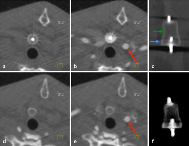 Angiographic C-arm CT visualization of the Woven EndoBridge Cerebral ...