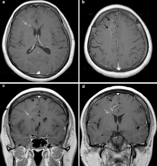 Magnetic Resonance Imaging Findings of Developmental Venous Anomalies ...