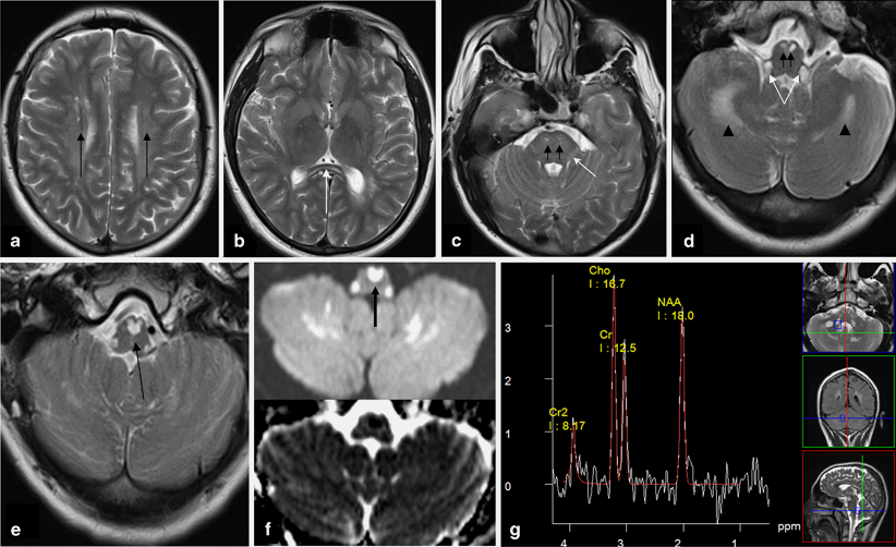 A Case with Leukoencephalopathy with Brainstem and Spinal Cord ...