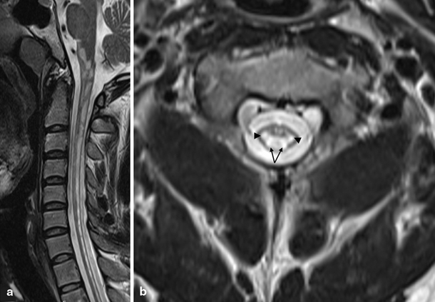 A Case with Leukoencephalopathy with Brainstem and Spinal Cord ...