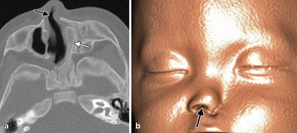 Diagnostic Imaging Features of Congenital Nose and Nasal Cavity Lesions ...