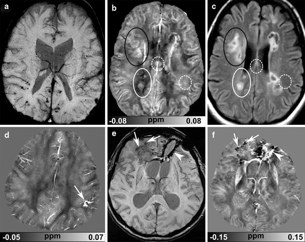 Quantitative Susceptibility Mapping: Concepts and Applications ...