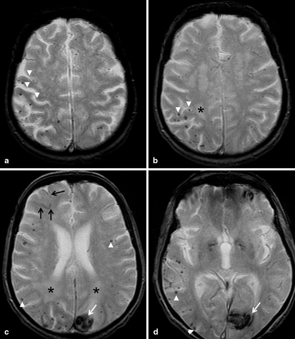 Imaging of Cerebral Microbleeds | SpringerLink