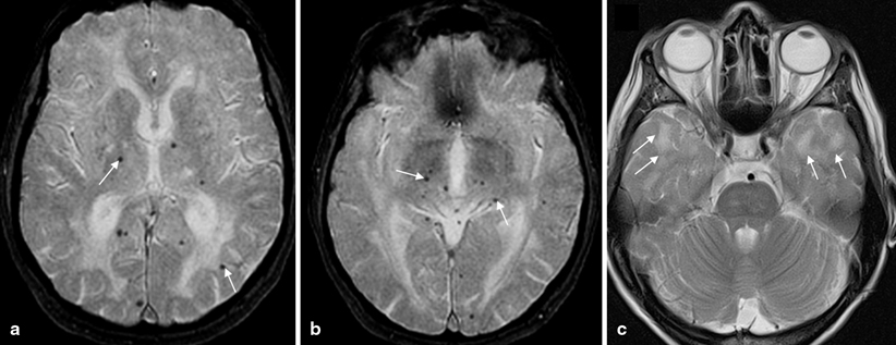 Imaging of Cerebral Microbleeds | SpringerLink