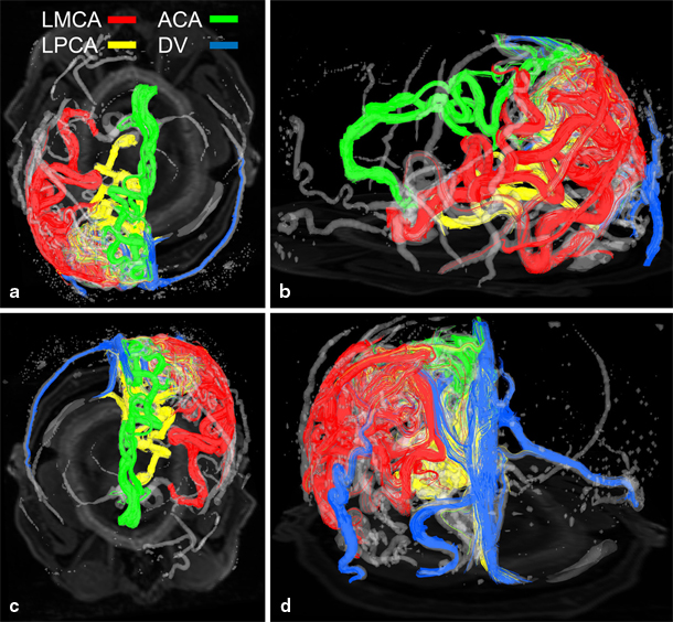 Combined DSA and 4D Flow Demonstrate Overt Alterations of Vascular Geometry and Hemodynamics in ...