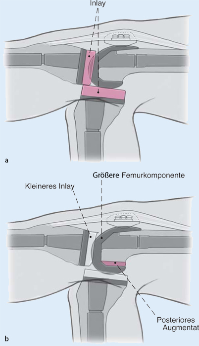 Knie-TEP-Revision auf ein halbgekoppeltes Prothesensystem mit der 3 ...