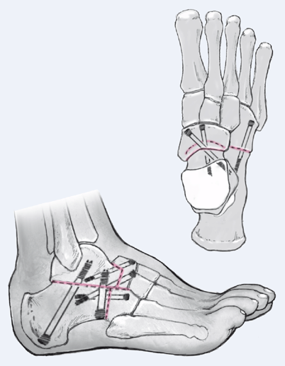 Modifizierte Arthrodese nach Lambrinudi mit zusätzlichem Transfer der ...