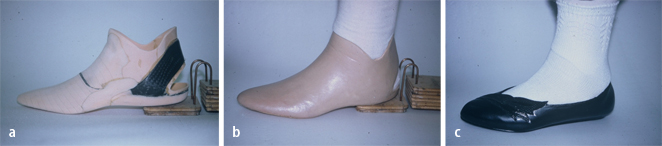 Amputationen am Rückfuß | SpringerLink