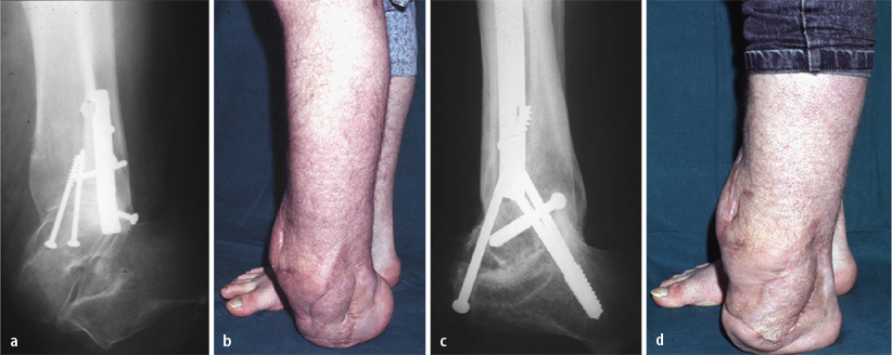 Amputationen am Rückfuß | SpringerLink
