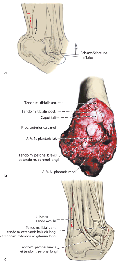 Amputationen am Rückfuß | SpringerLink