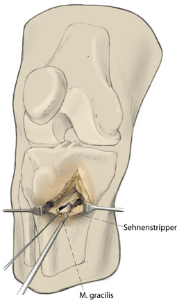 Anatomische Rekonstruktion des medialen patellofemoralen Bands mit ...