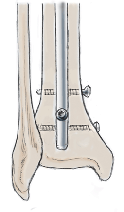 Intramedulläre Nagelung von proximalen Tibiafrakturen | SpringerLink