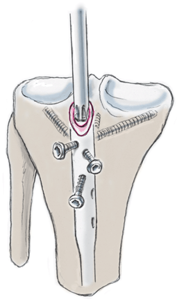 Intramedulläre Nagelung von proximalen Tibiafrakturen | SpringerLink