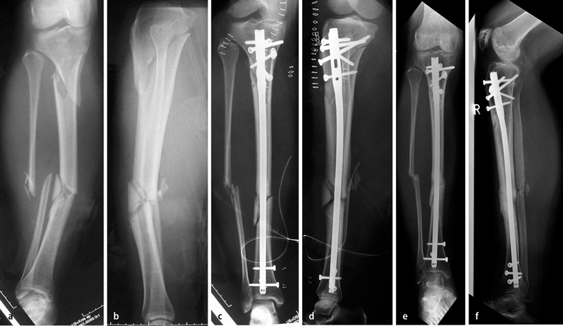 Intramedulläre Nagelung von proximalen Tibiafrakturen | SpringerLink