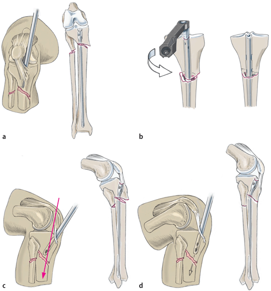 Intramedulläre Nagelung von proximalen Tibiafrakturen | SpringerLink