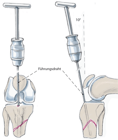 Intramedulläre Nagelung von proximalen Tibiafrakturen | SpringerLink