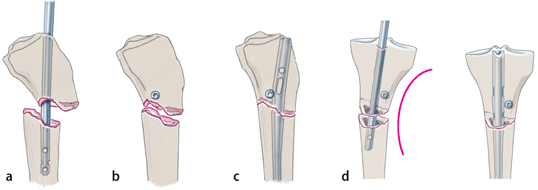 Intramedulläre Nagelung von proximalen Tibiafrakturen | SpringerLink