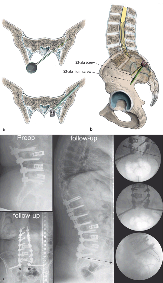 Reinforcement of lumbosacral instrumentation using S1–pedicle screws ...
