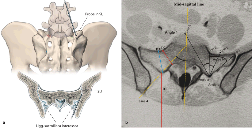 Reinforcement of lumbosacral instrumentation using S1–pedicle screws ...
