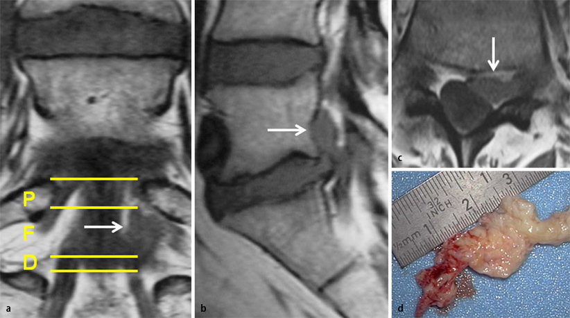 The translaminar approach for cranially extruded lumbar disc ...
