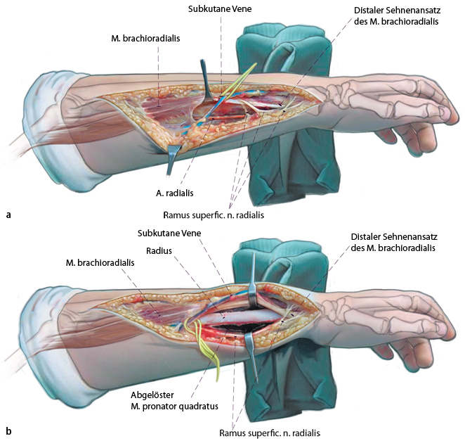Rerouting des Musculus brachioradialis zur Verbesserung der ...
