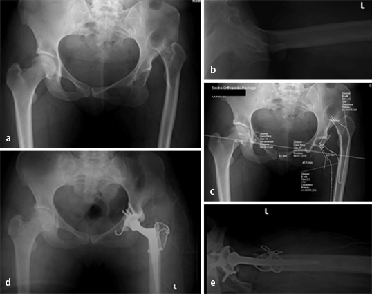 Die operative Versorgung der sekundären Coxarthrose bei kongenitaler ...