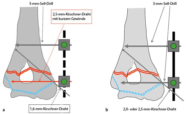 Radialer externer Fixateur zur geschlossenen Behandlung problematischer ...